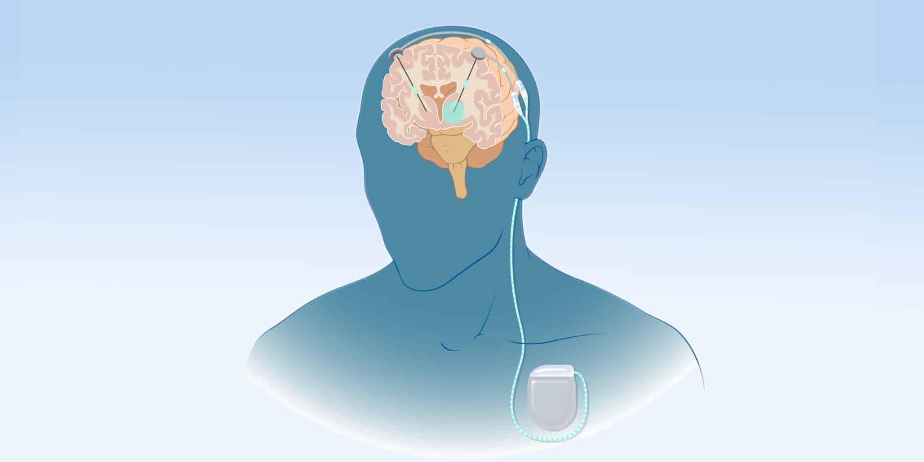 Brain Stimulation for Uncontrolled Seizures - Epilepsy Foundation of ...